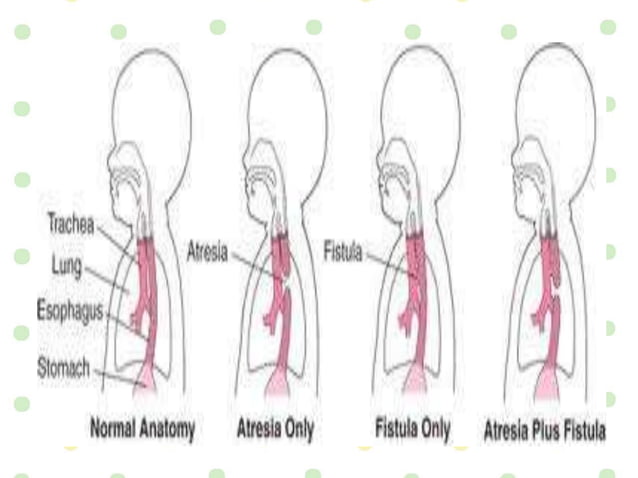 Atresia esofagus | PPTX