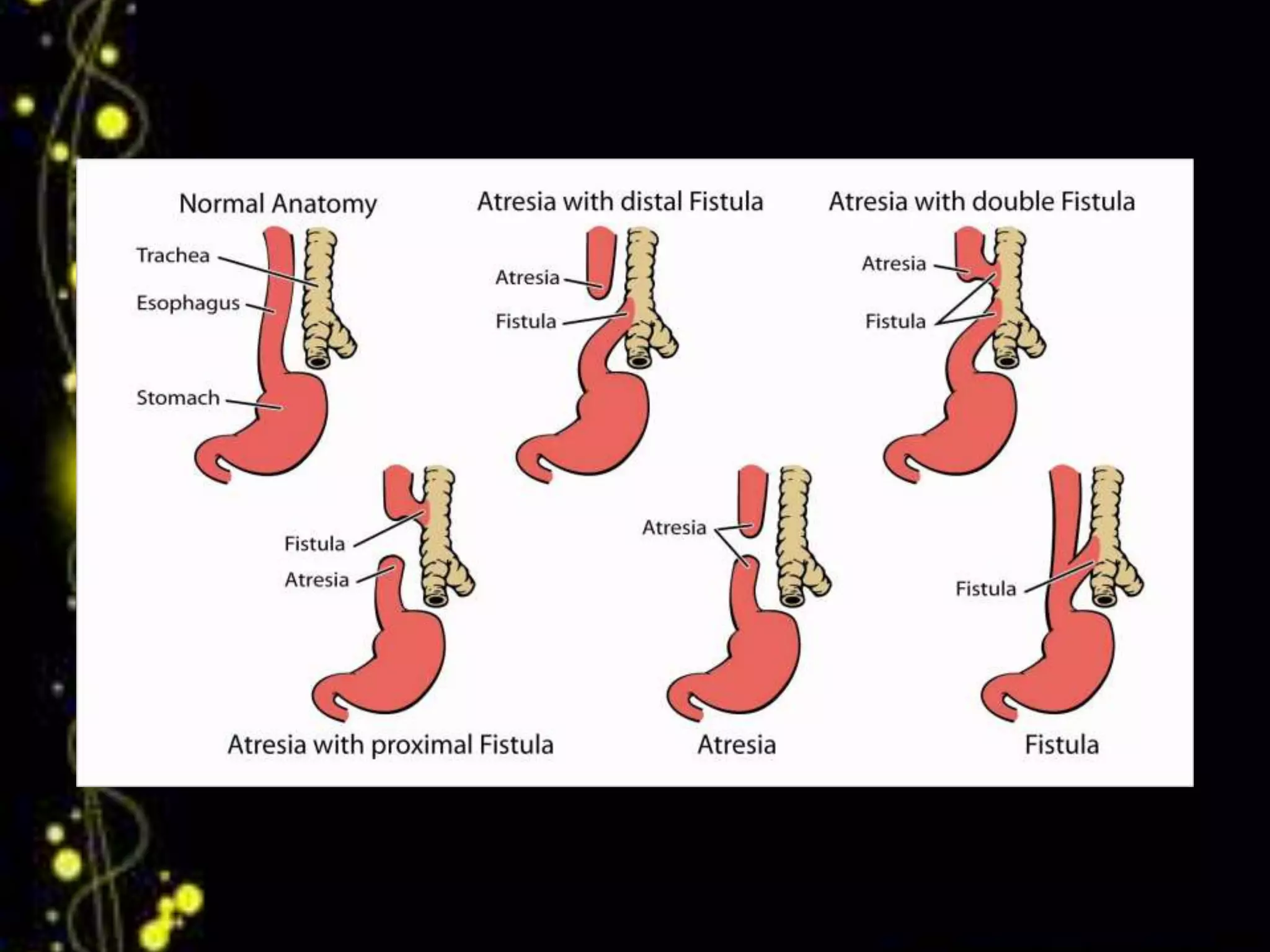 Atresia Esofagus | PPTX