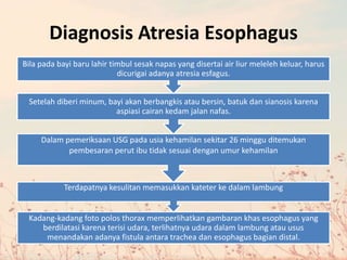Atresia Esofagus | PPTX