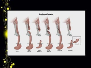 Atresia Esofagus | PPT