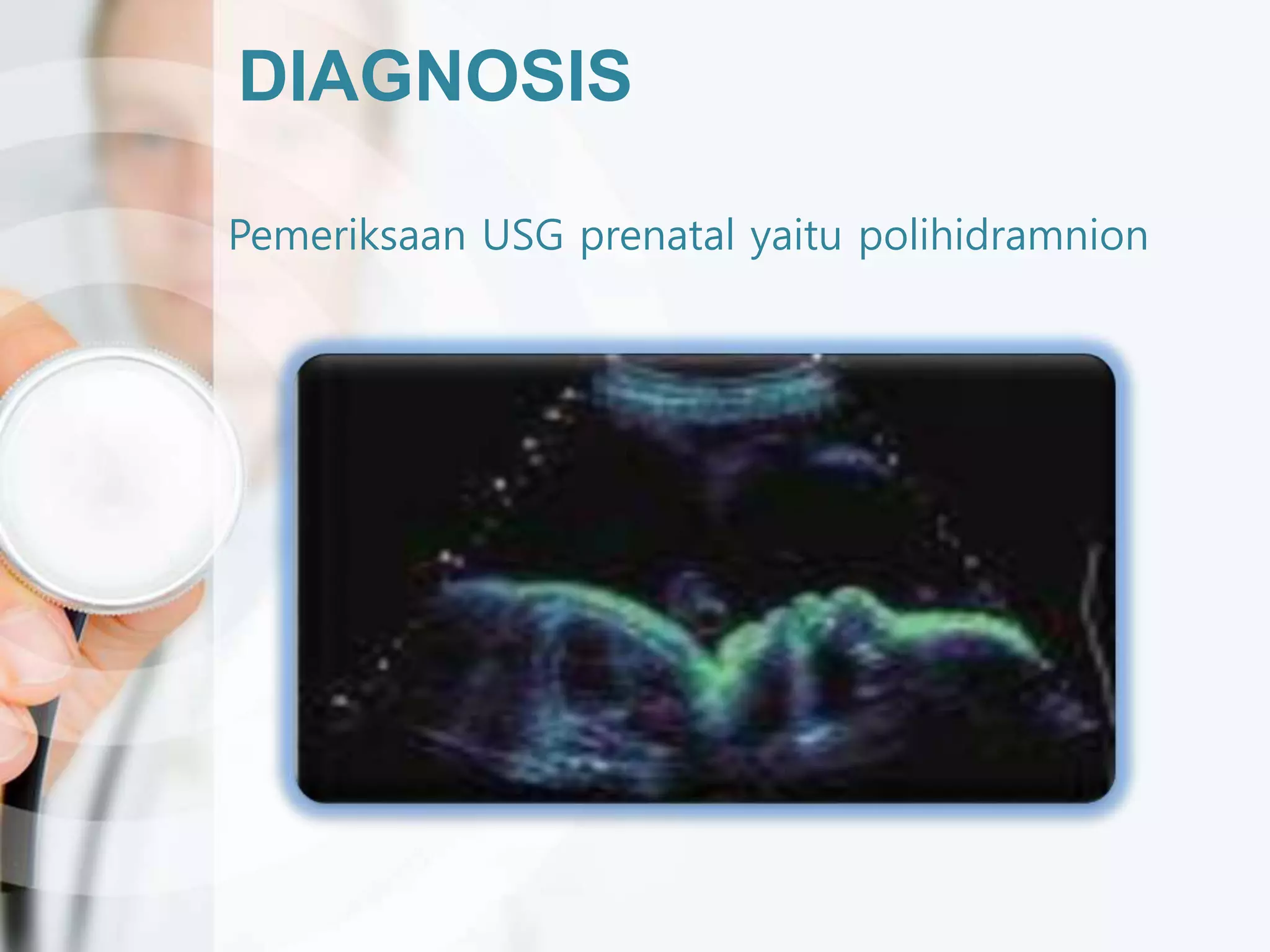 Atresia esofagus | PPTX