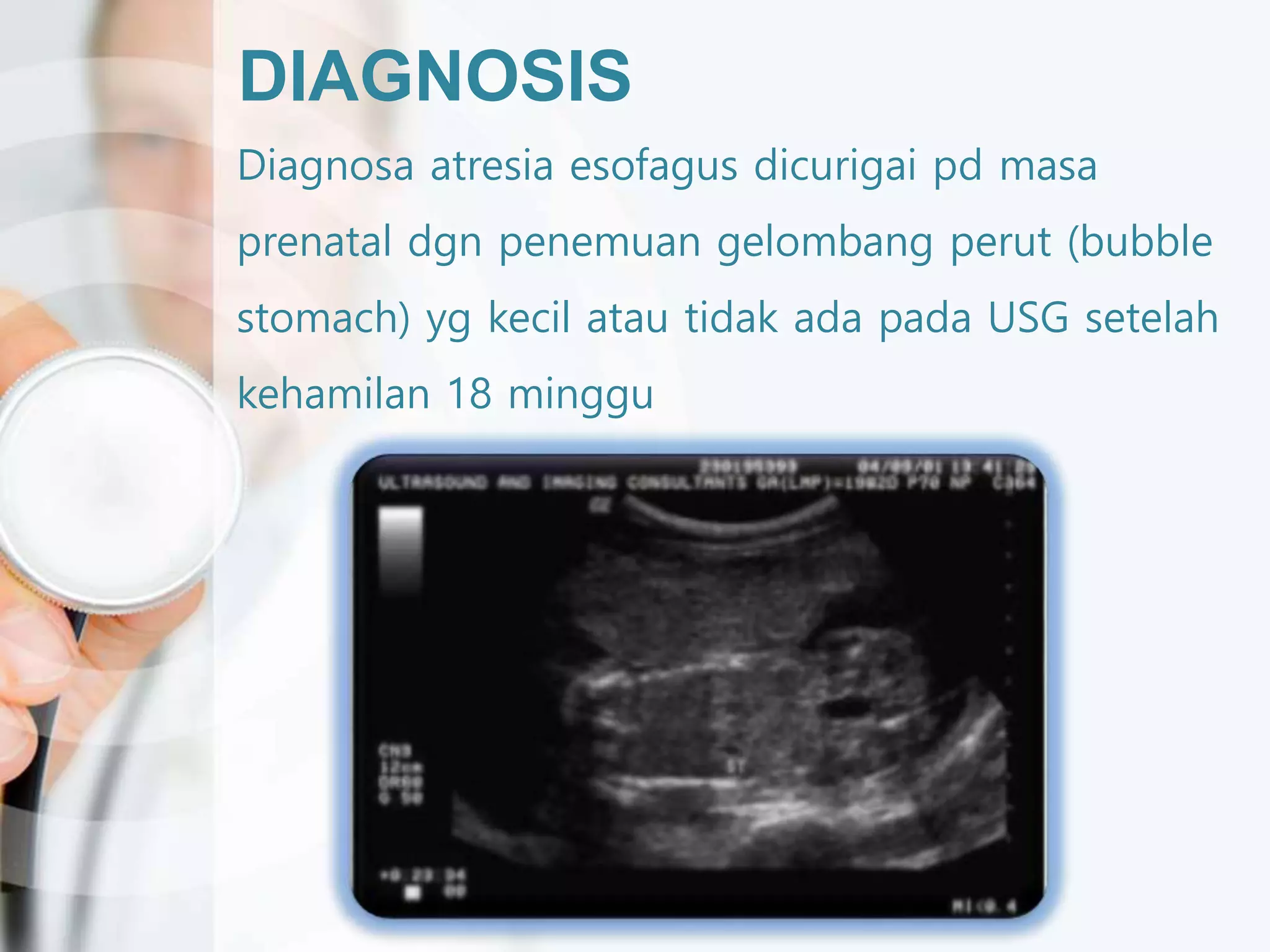 Atresia esofagus | PPTX