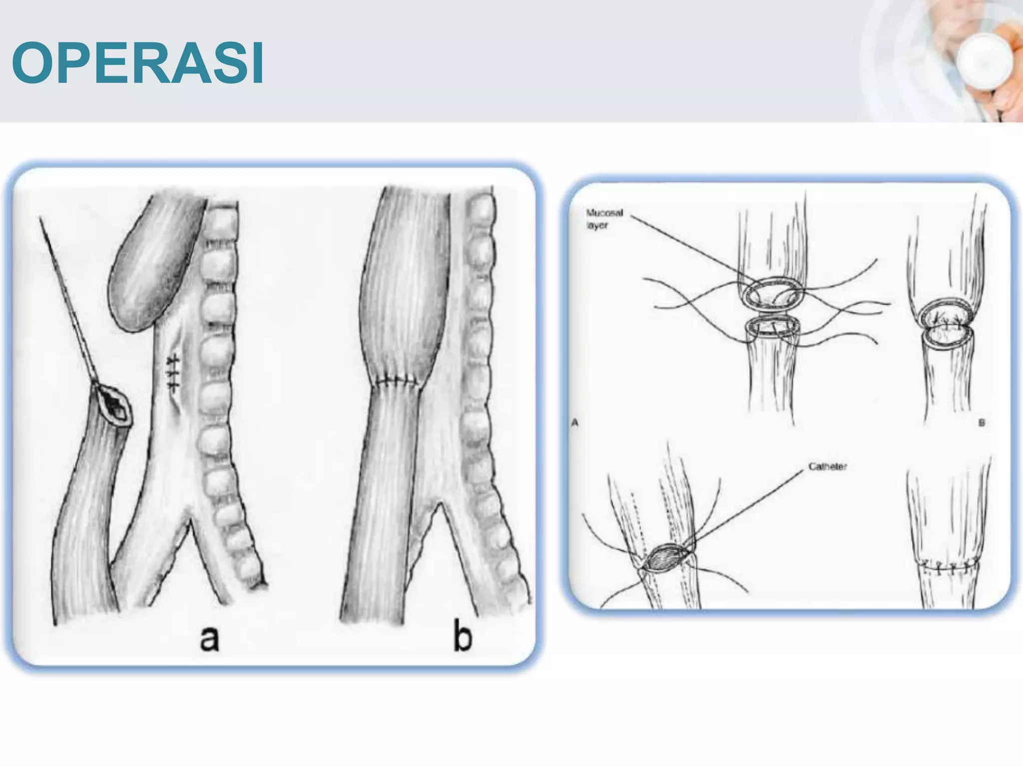 Atresia esofagus | PPTX
