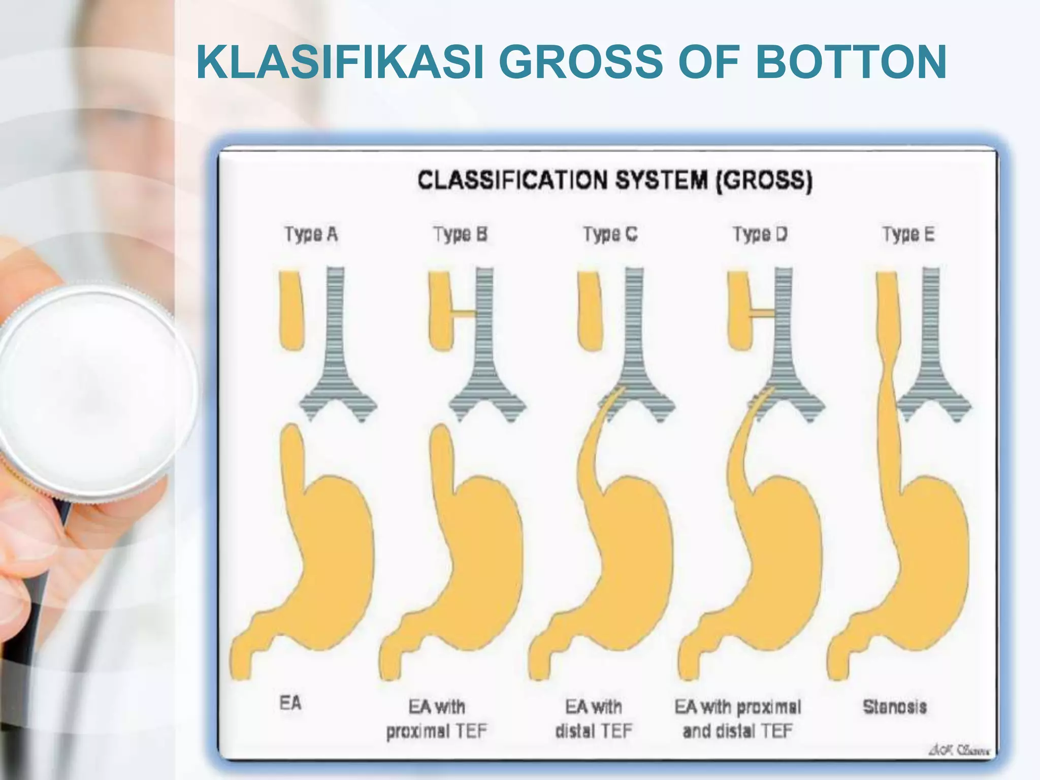 Atresia esofagus | PPTX