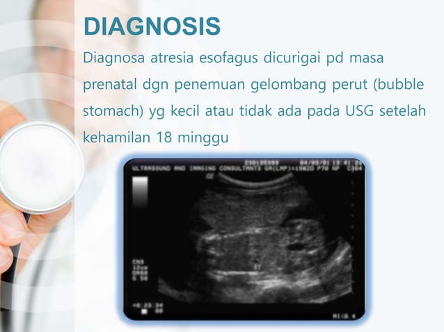 Atresia esofagus | PPTX