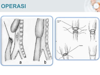 Atresia esofagus | PPTX