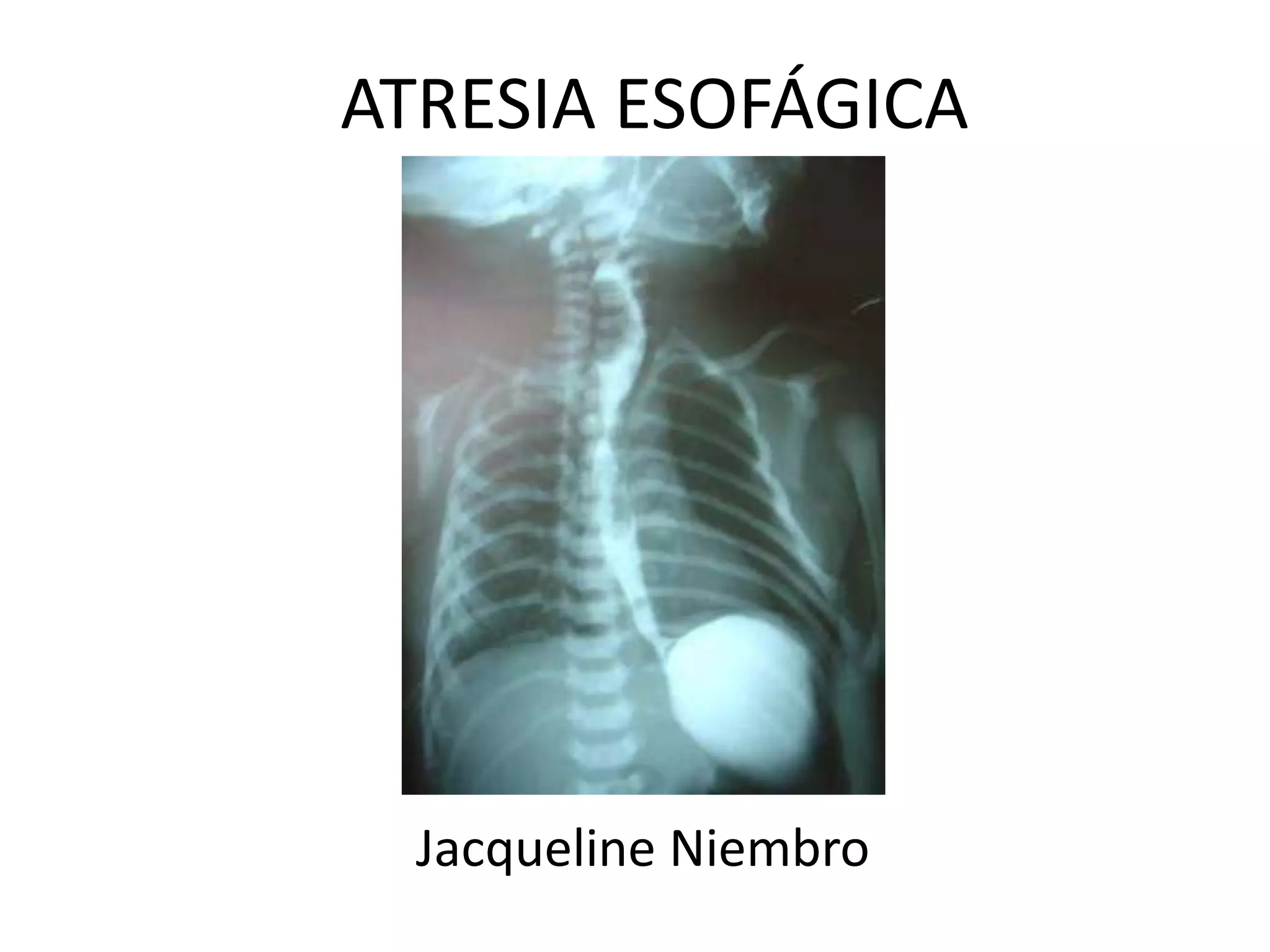 Atresia esofágica | PPTX