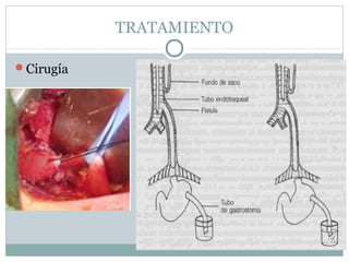 Atresia esofágica presentación