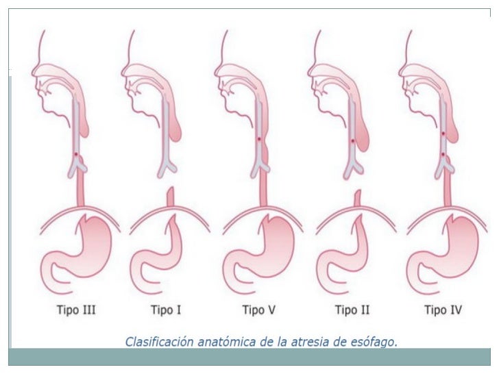 Atresia esofágica presentación