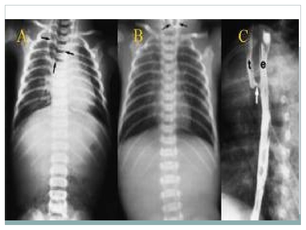 Atresia esofágica presentación