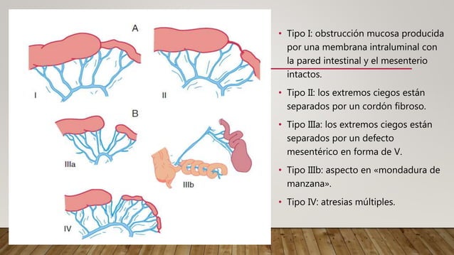 Atresia, estenosis y malrotacion intestinal.pptx