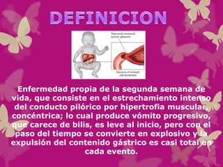 Estenosis hipertrofica del piloro | PPTX