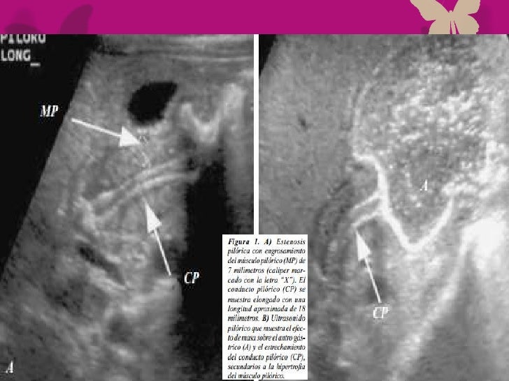 Estenosis hipertrofica del piloro