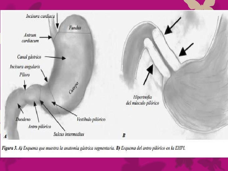 Estenosis hipertrofica del piloro