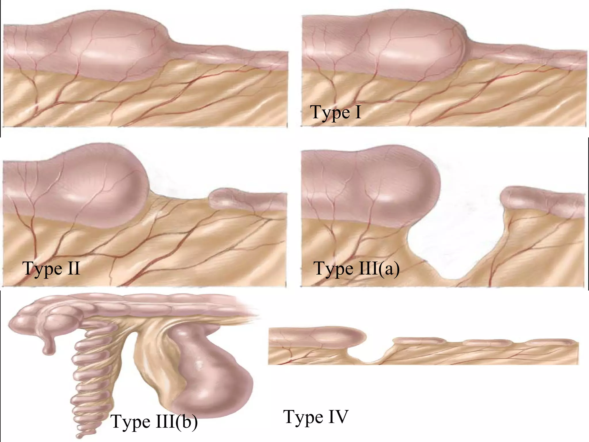 Atresia ileum | PPT