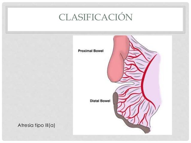 Atresia intestinal