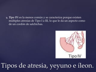 Atresia intestinal | PPTX