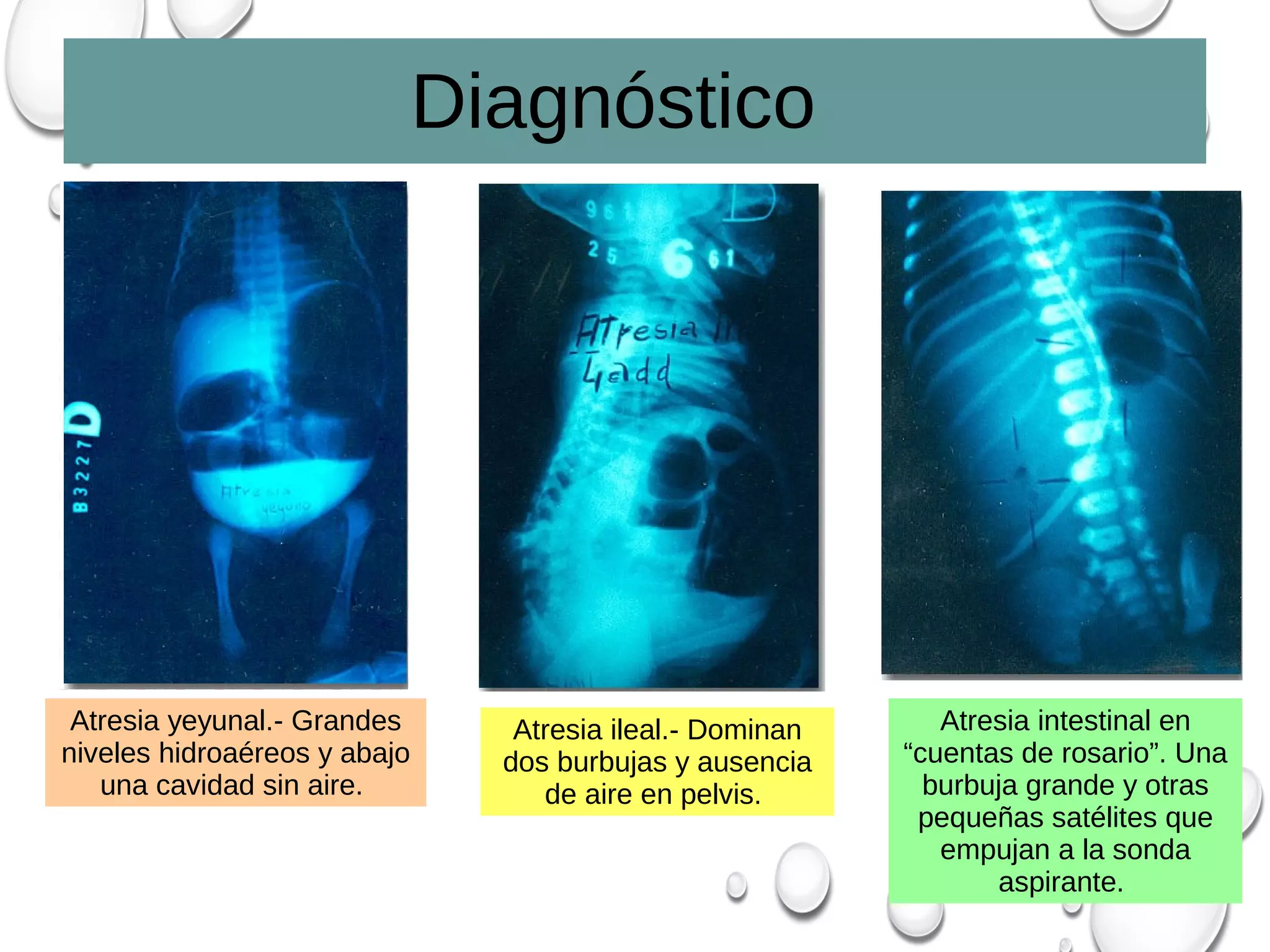 Atresia intestinal | ODP