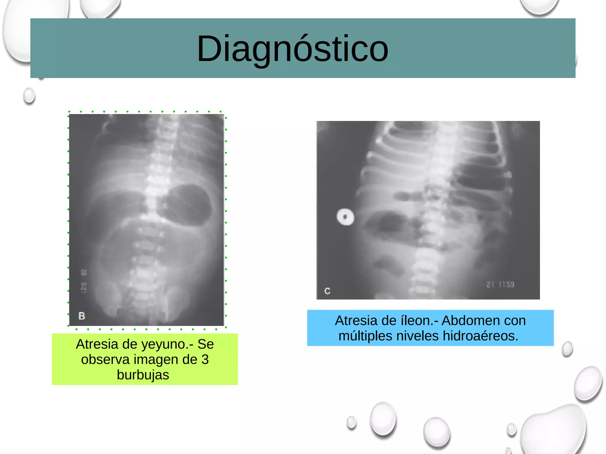 Atresia intestinal | ODP