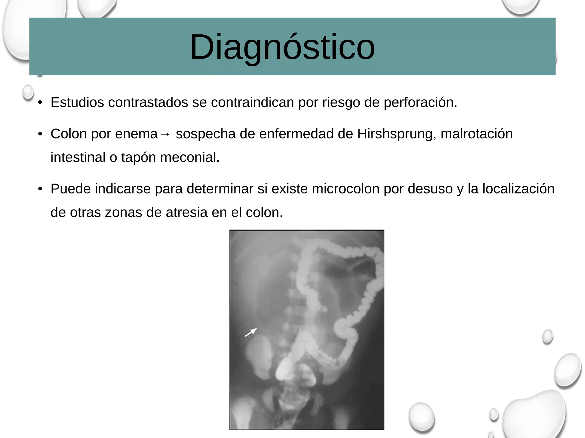 Atresia intestinal | ODP