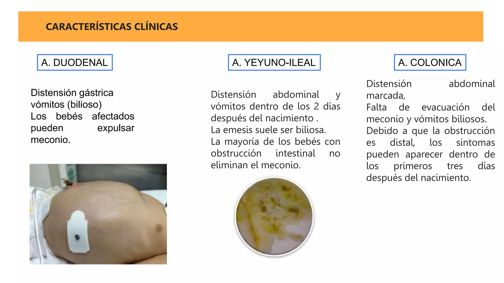 ATRESIA_INTESTINAL.pptx