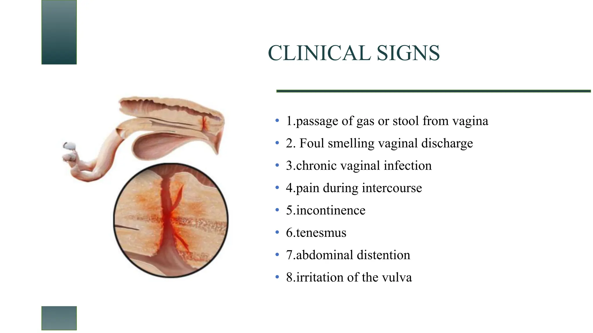 Atresi ani and Recto-vaginal fistula.pptx