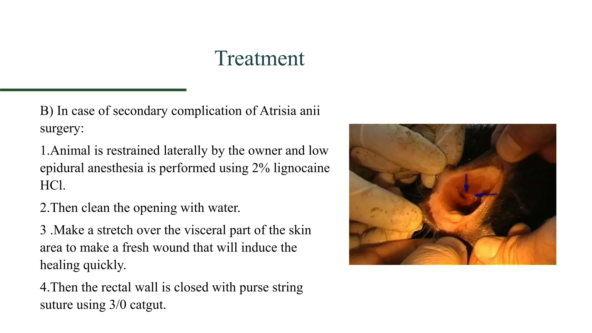 Atresi ani and Recto-vaginal fistula.pptx