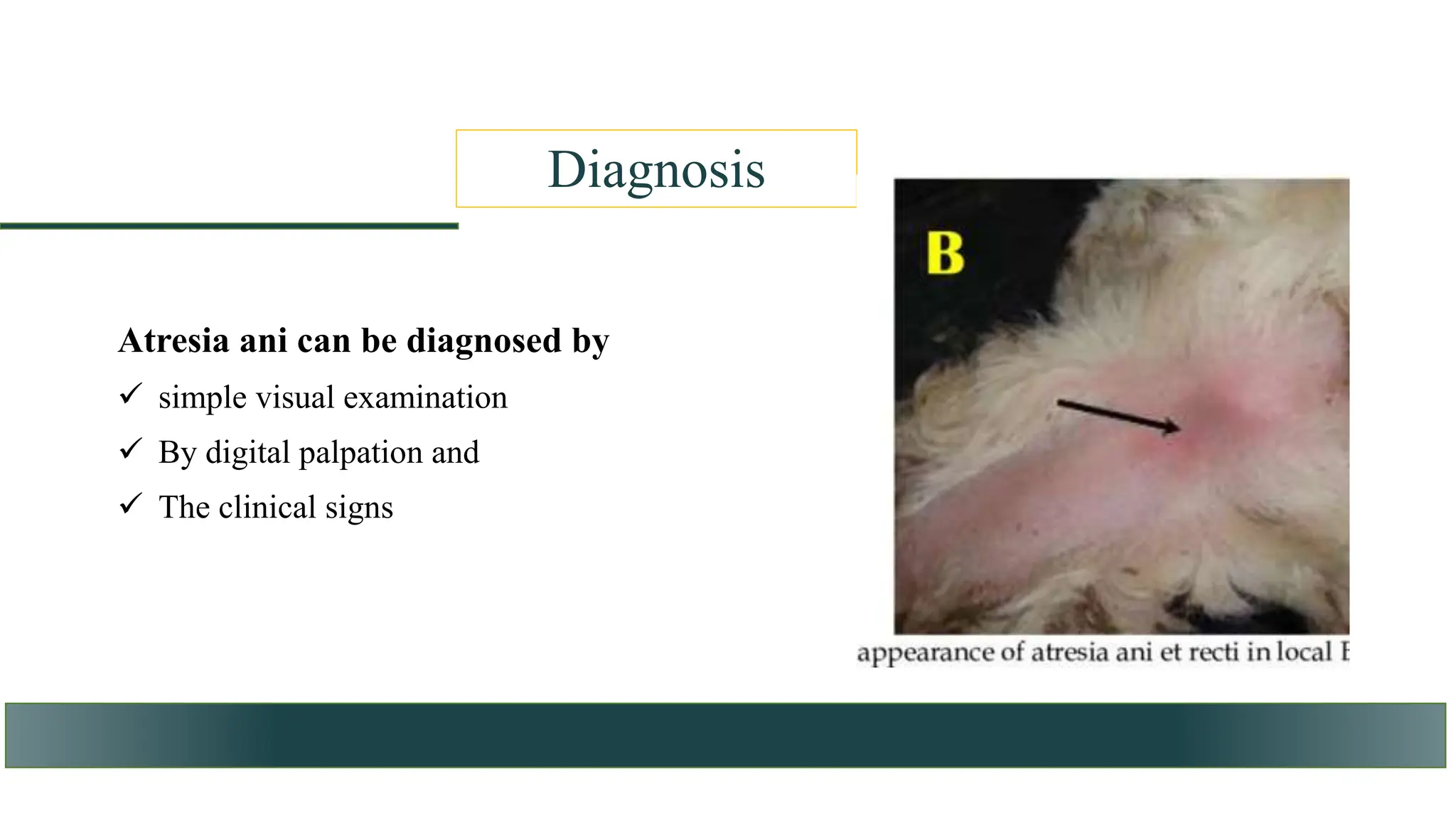 Atresi ani and Recto-vaginal fistula.pptx