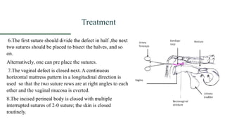 Atresi ani and Recto-vaginal fistula.pptx