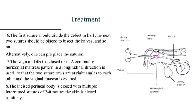Atresi ani and Recto-vaginal fistula.pptx