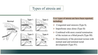 Atresi ani and Recto-vaginal fistula.pptx