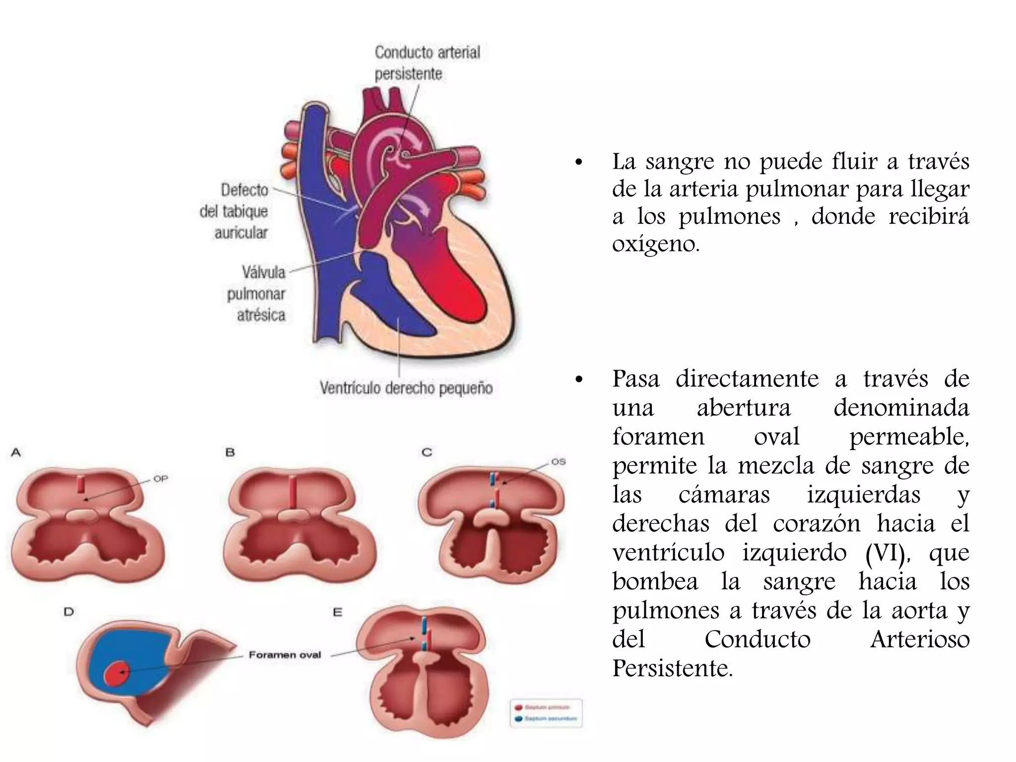 Atresia pulmonar | PPTX