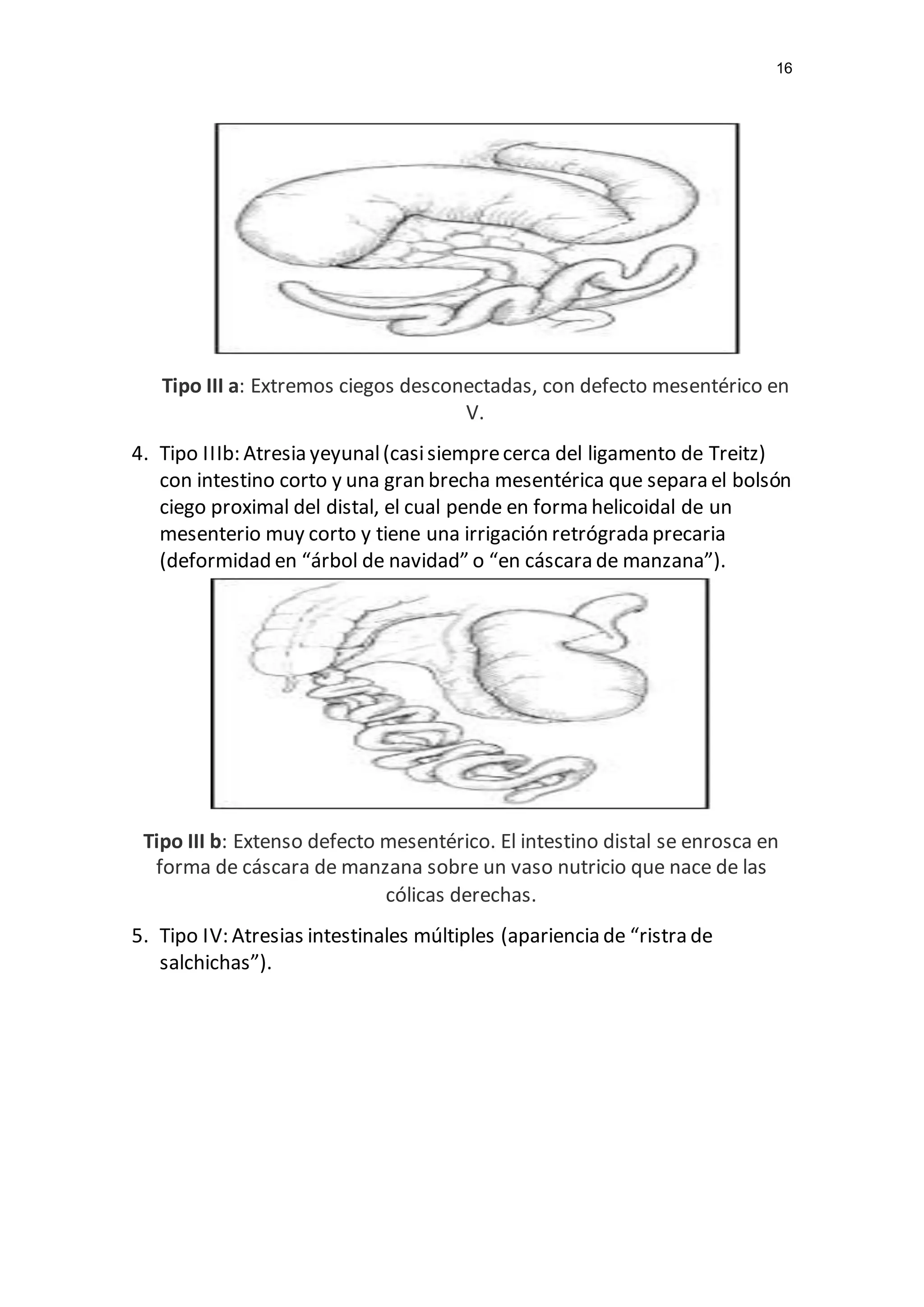Atresias intestinales y anorectales | DOCX