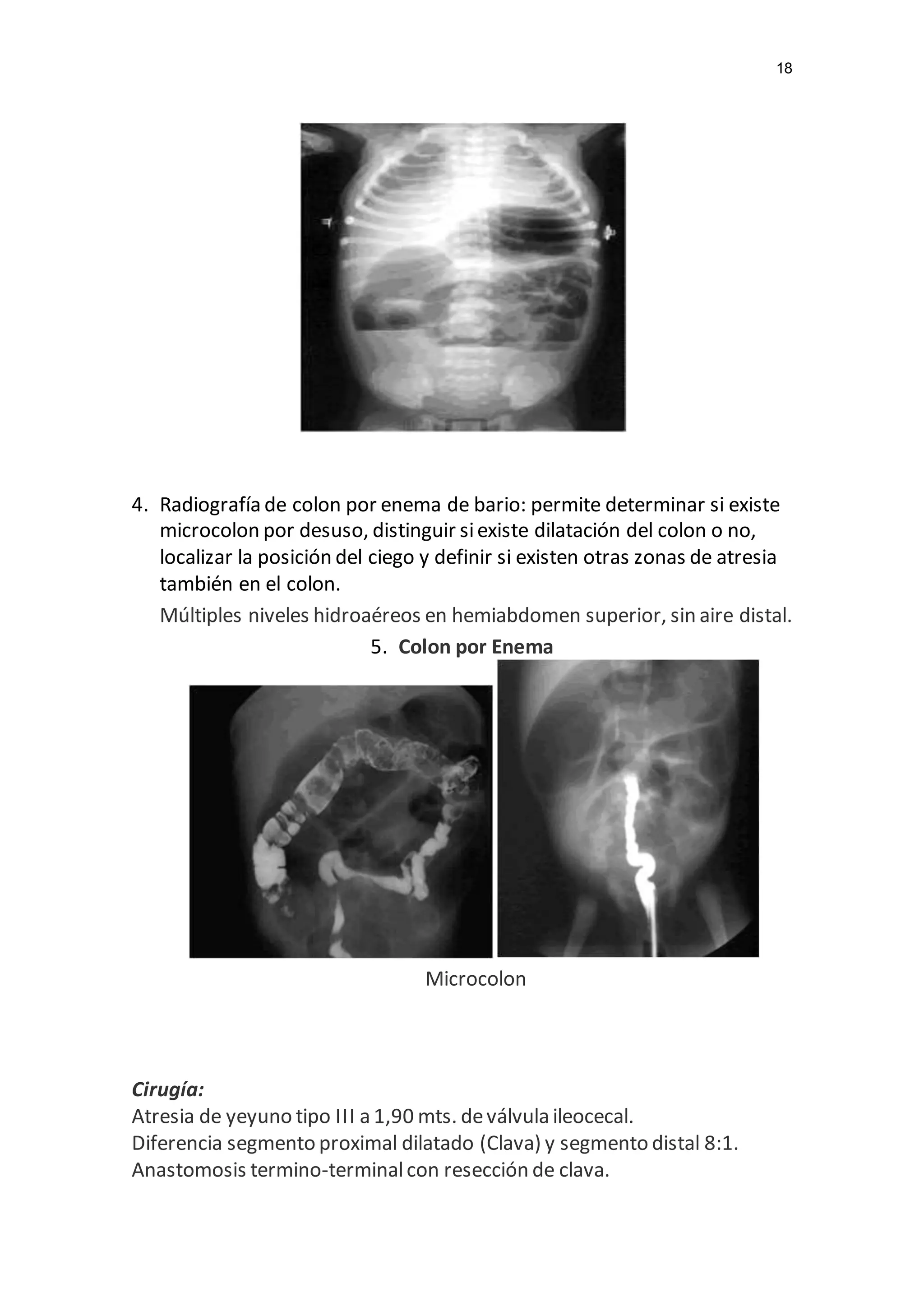 Atresias intestinales y anorectales | DOCX