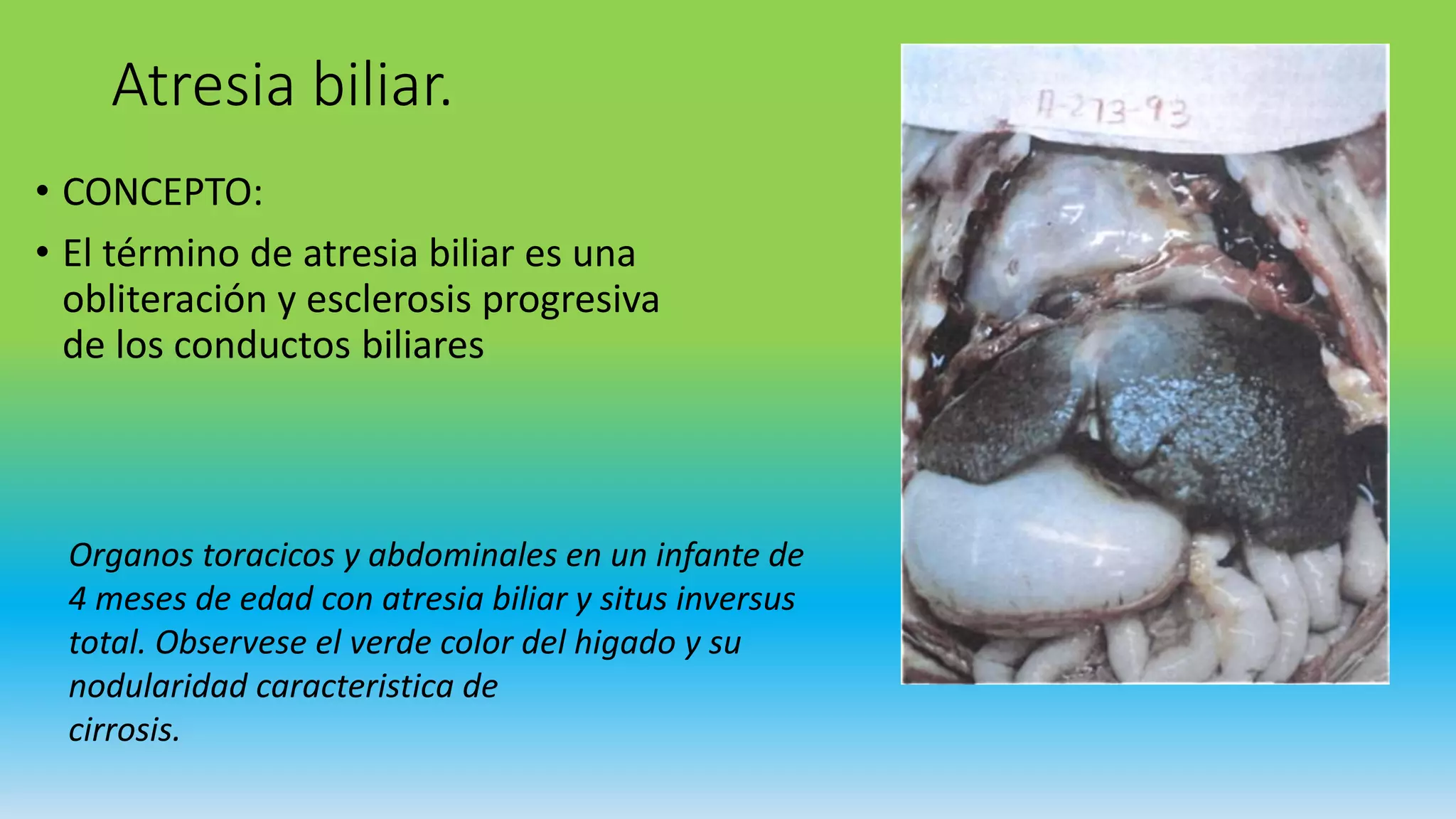 Atresia vias biliares rolo | PPTX | Digestive Disorders | Diseases and ...