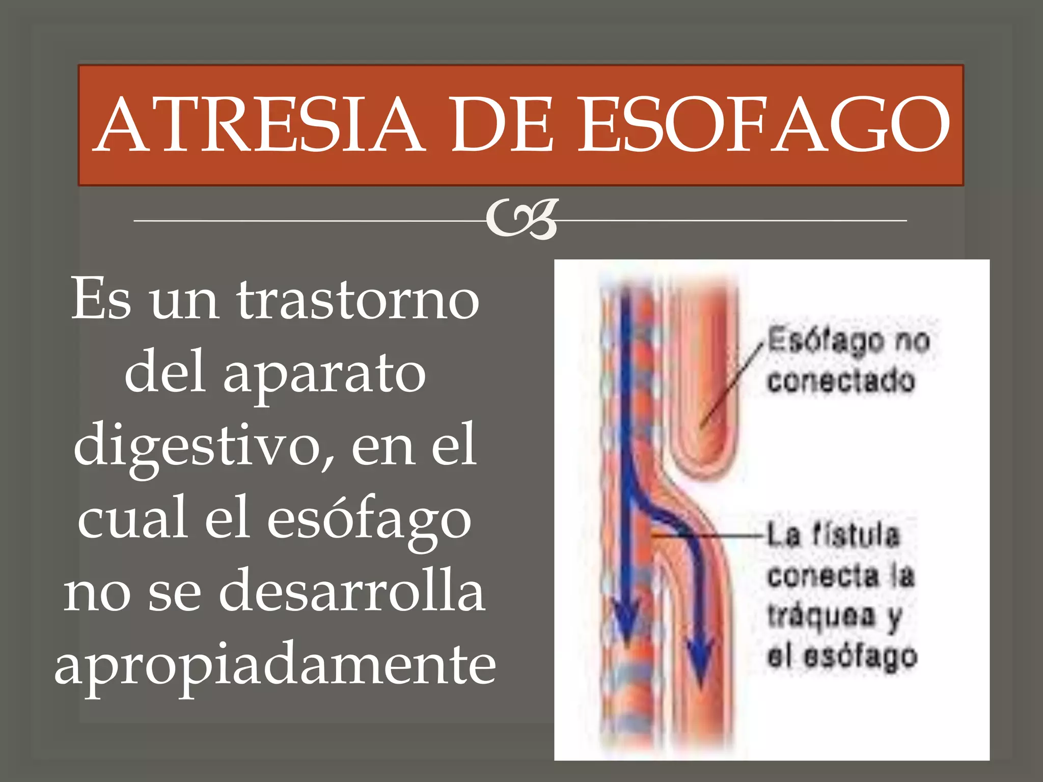 Atresia esofagica en enfermería | PPTX