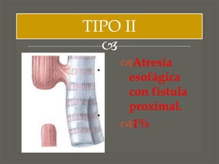 Atresia esofagica en enfermería | PPTX