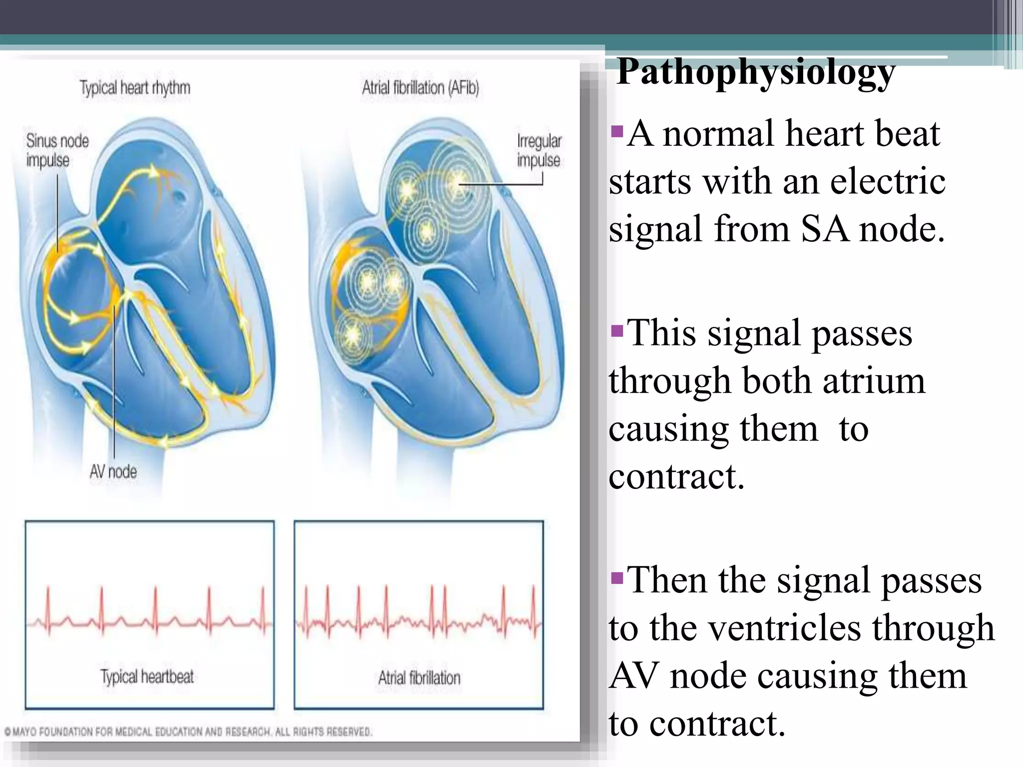 ATRIAL-FIBRILLATION.pptx