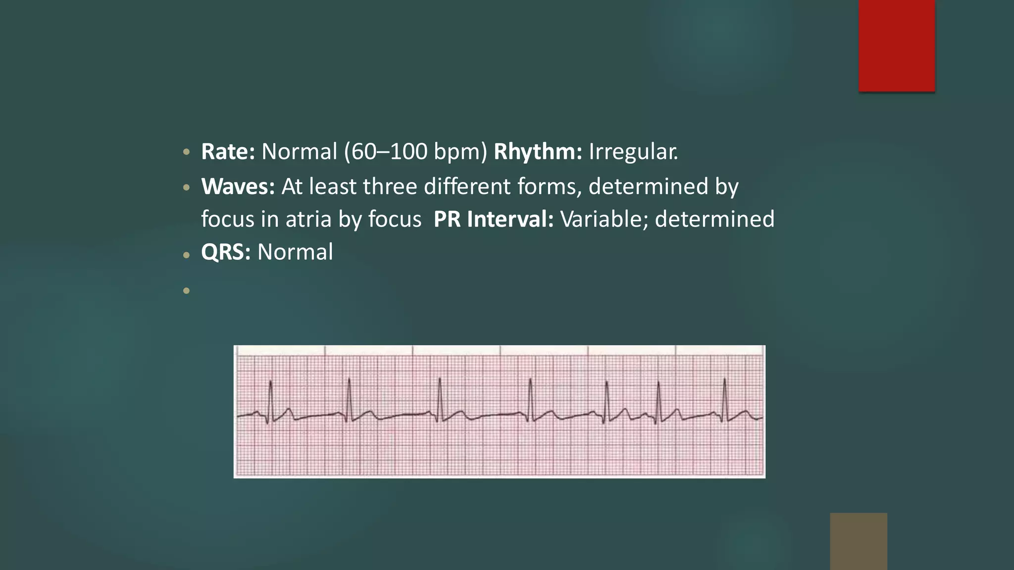 Atrial arrhythmia | PPTX