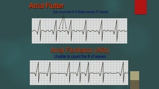 Atrial arrhythmia | PPTX | Heart and Cardiovascular Diseases | Diseases ...