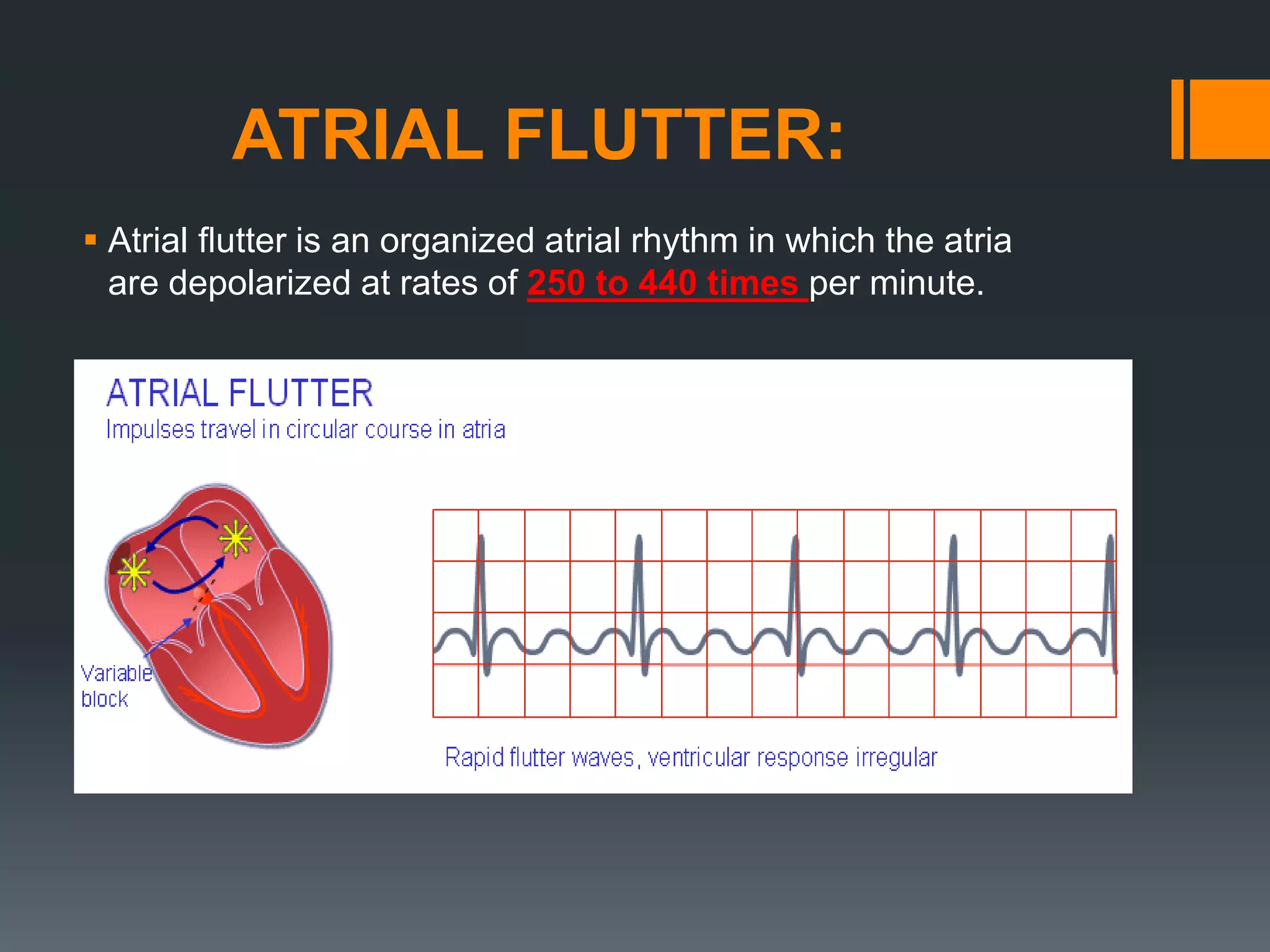 ATRIAL ARRHYTHMIAS | PPTX
