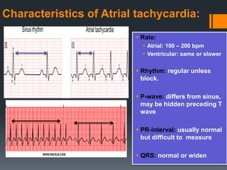 ATRIAL ARRHYTHMIAS | PPTX