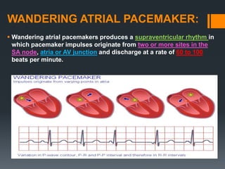 ATRIAL ARRHYTHMIAS | PPTX