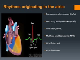 ATRIAL ARRHYTHMIAS | PPTX