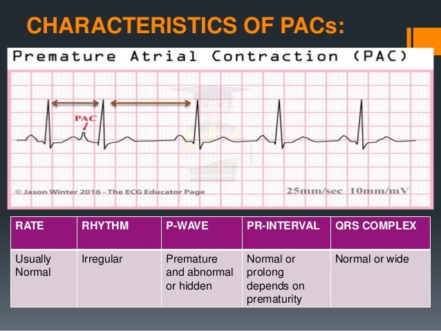 ATRIAL ARRHYTHMIAS