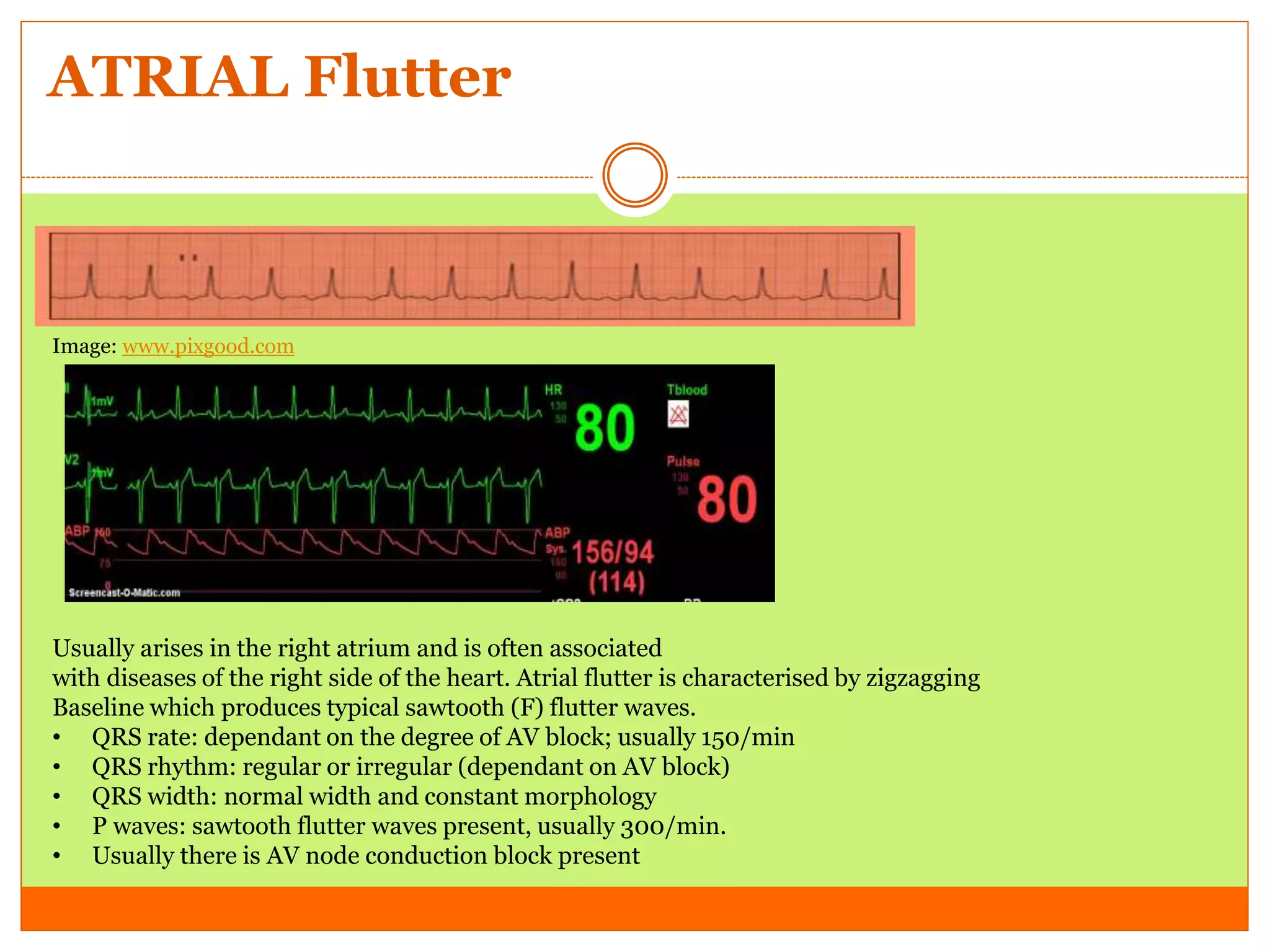 Atrial arrhythmias(2) | PPT