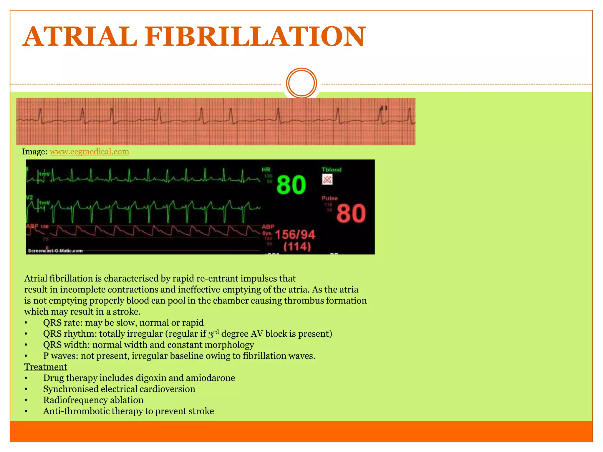 Atrial arrhythmias(2) | PPTX