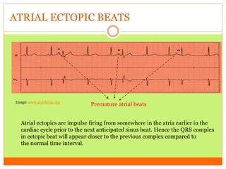 Atrial arrhythmias(2) | PPT