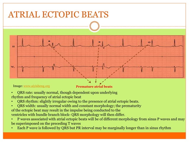 Atrial arrhythmias(2) | PPT