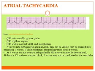 Atrial arrhythmias(2) | PPT